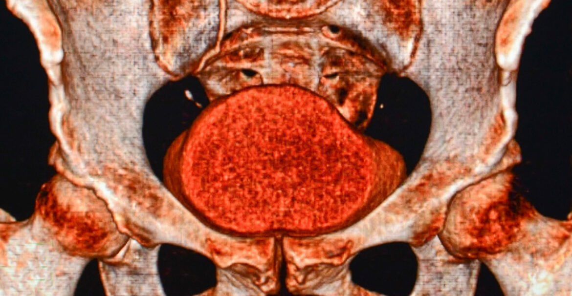 Voiding Dysfunction - Dr. Kai-Wen Chuang