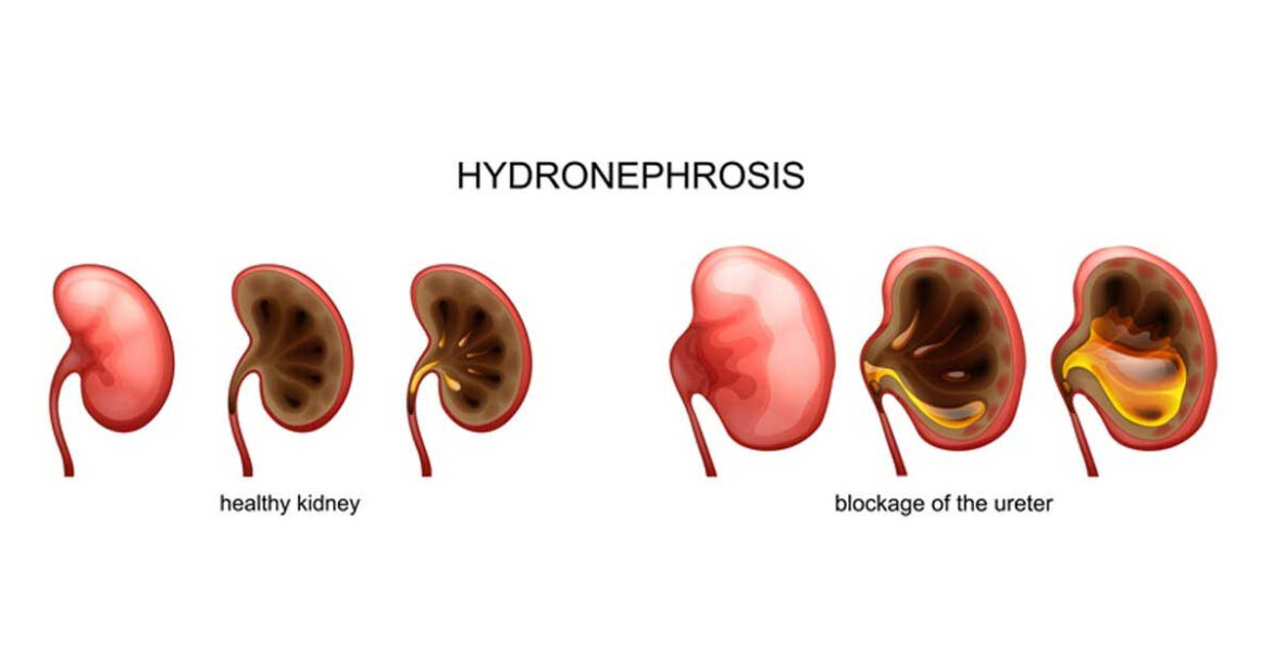 Hydronephrosis - Dr. Kai-Wen Chuang
