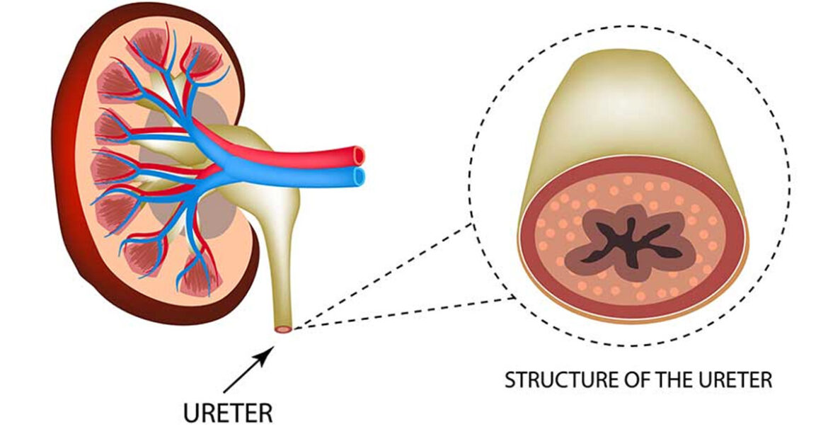 Ureteral Duplication - Dr. Kai-Wen Chuang